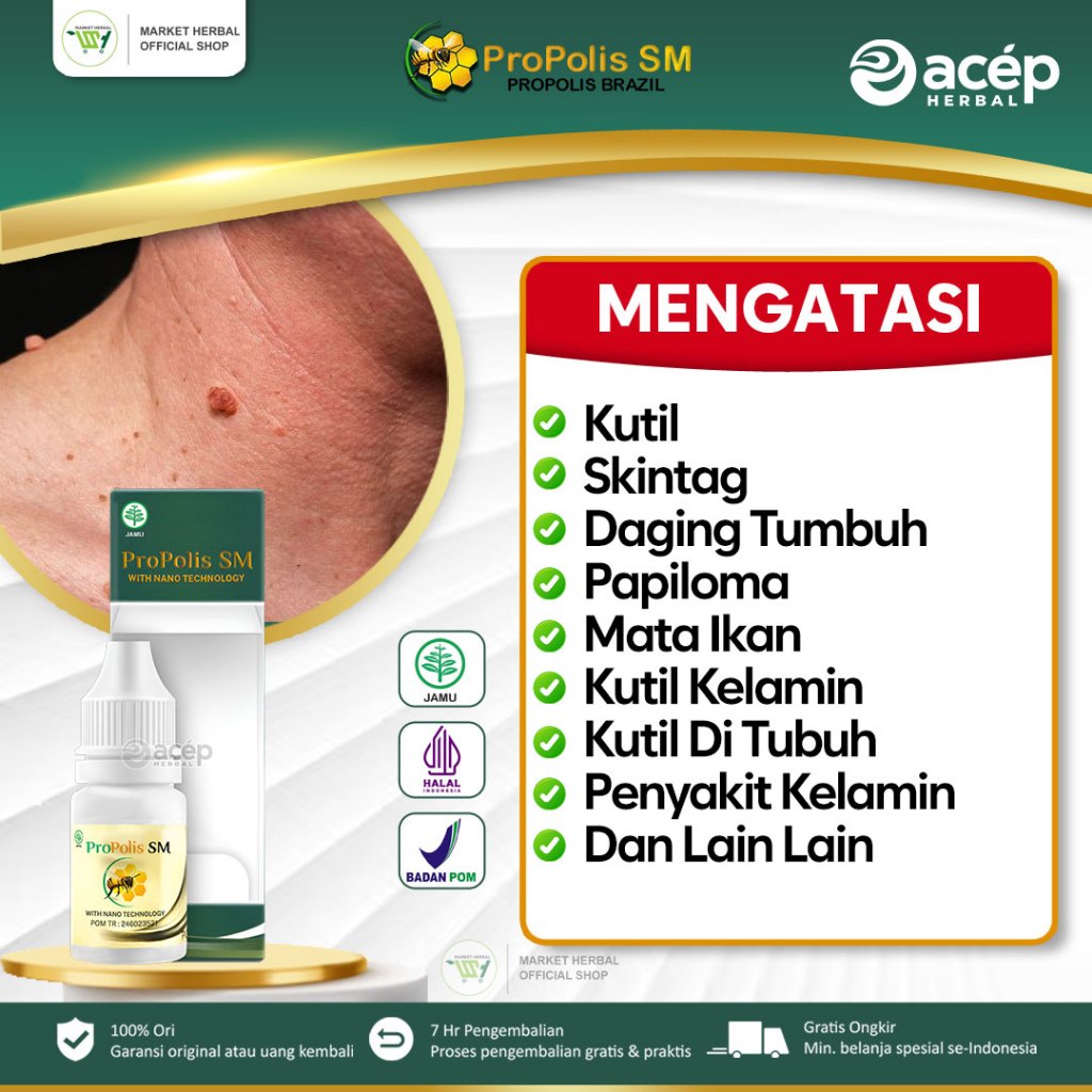 Jual Obat Kutil Skin Tag Milia Daging Jadi Mata Ikan Lipoma Kelenjar ...
