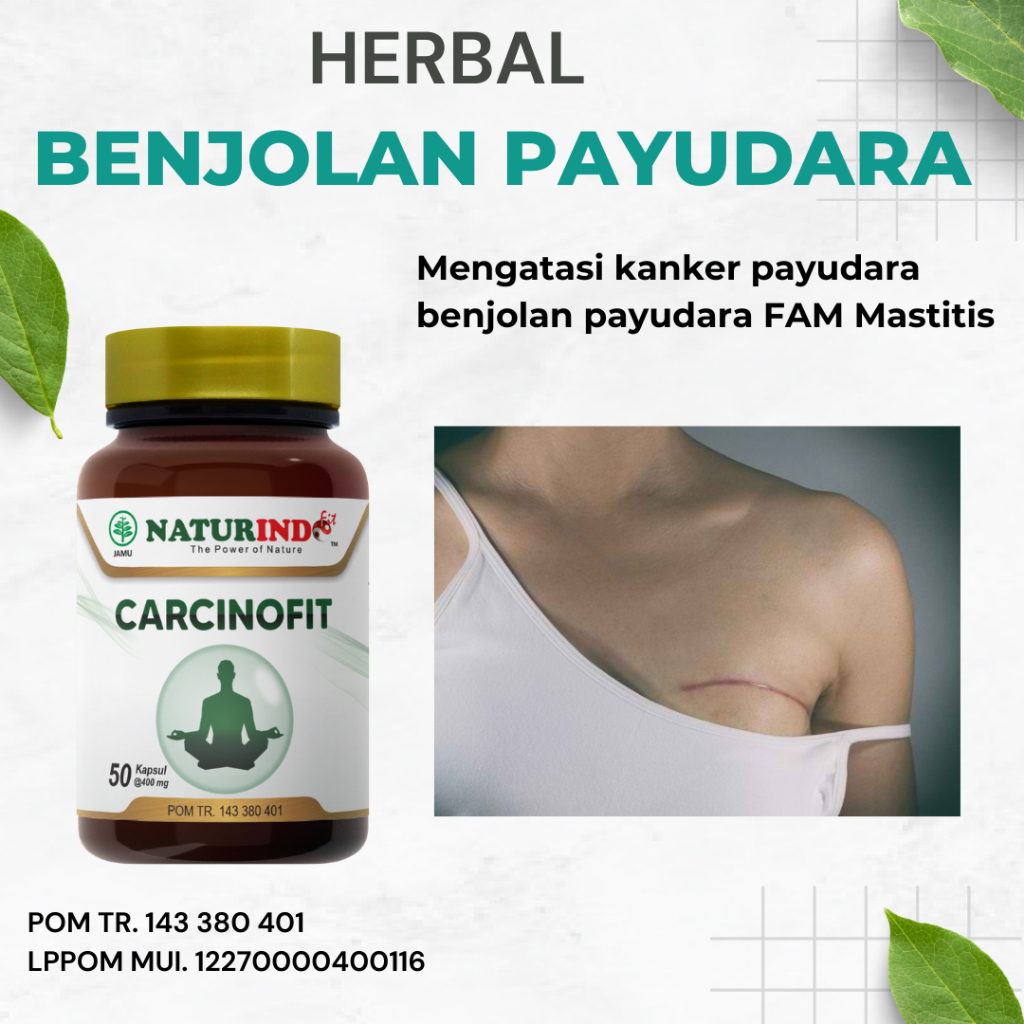 Jual Obat Benjolan Payudara Kanker Ganas Tumor Mastitis Fam | Shopee ...