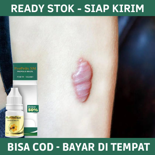Jual Obat Keloid, Obat Untuk Keloid, Obat Keloid di Telinga, Obat ...
