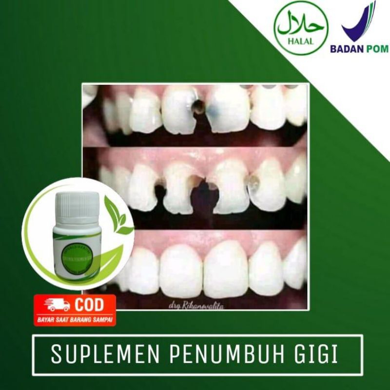 Jual SUPLEMEN PENUMBUH GIGI BOLONG KROPOS DAN OMPONG PERMANEN | Shopee ...