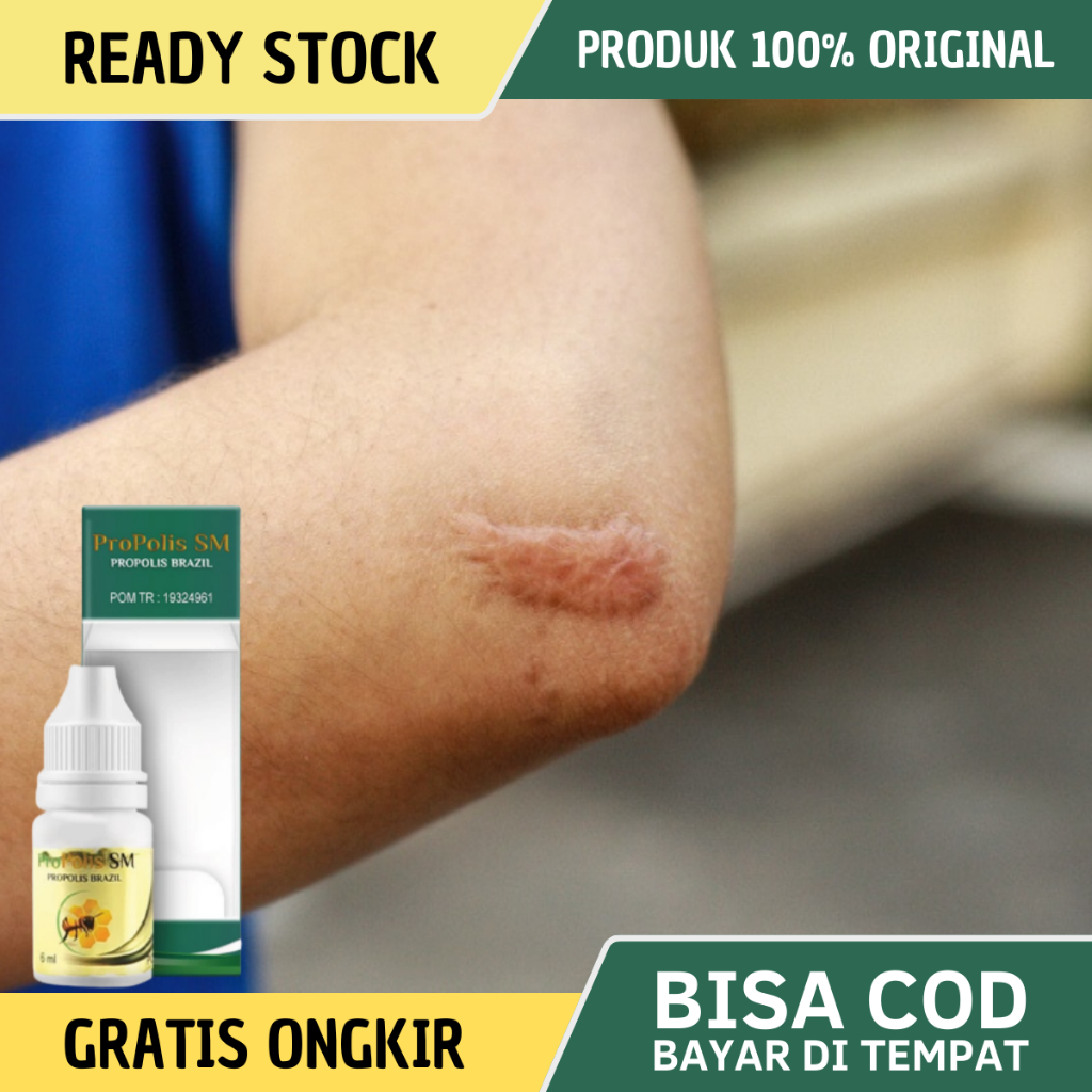 Jual Obat Keloid Daging Tumbuh, Obat Keloid Menahun, Obat Daging Jadi ...