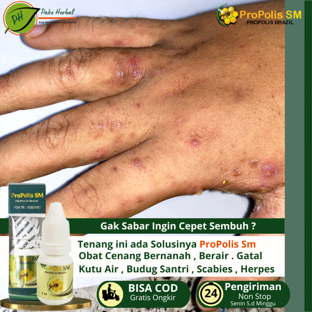 Jual Propolis Sm Asli Herbal Cairan Mampu Mengobati Cenang Bernanah ...
