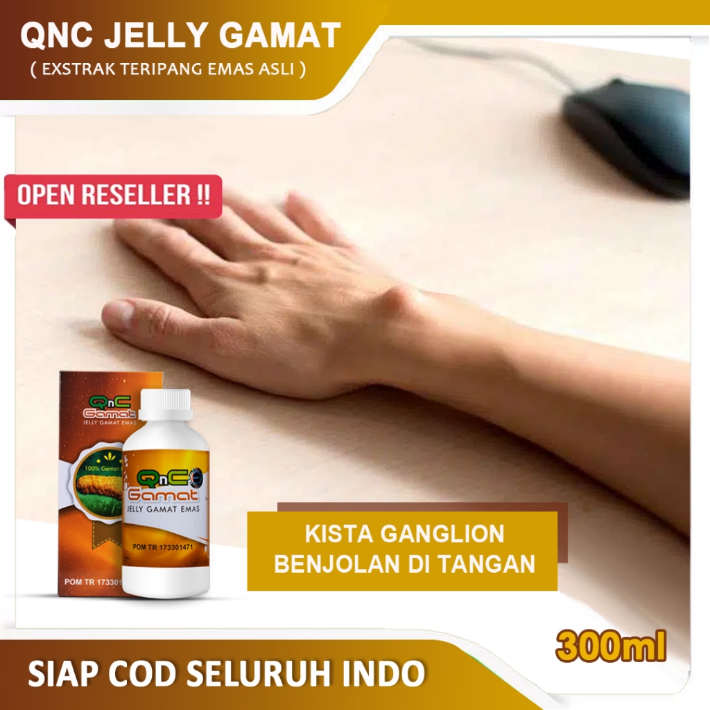 Jual Obat Kista Ganglion Benjolan Di Pergelangan Tangan Mengecilkan ...
