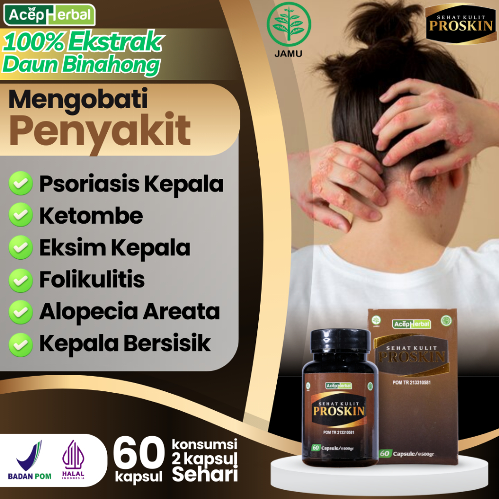Jual Obat Psoriasis, Obat Kepala Ketombe. Obat Eksim Kepala, Obat ...