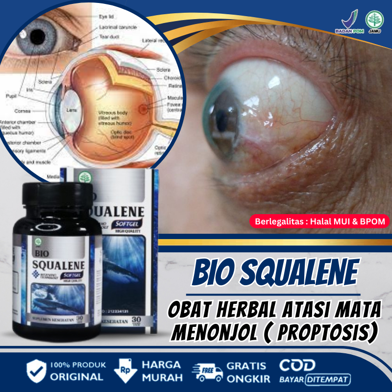 Jual Obat Mata Menonjol Akibat Hipertiroid Bengkak, Obat Mata Tiroid ...