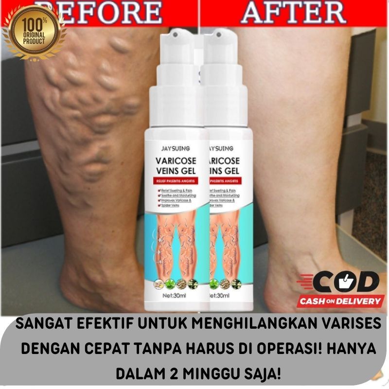 Jual Gel Varikose Asli Original Obat Varises Paling Ampuh Kaki dan ...