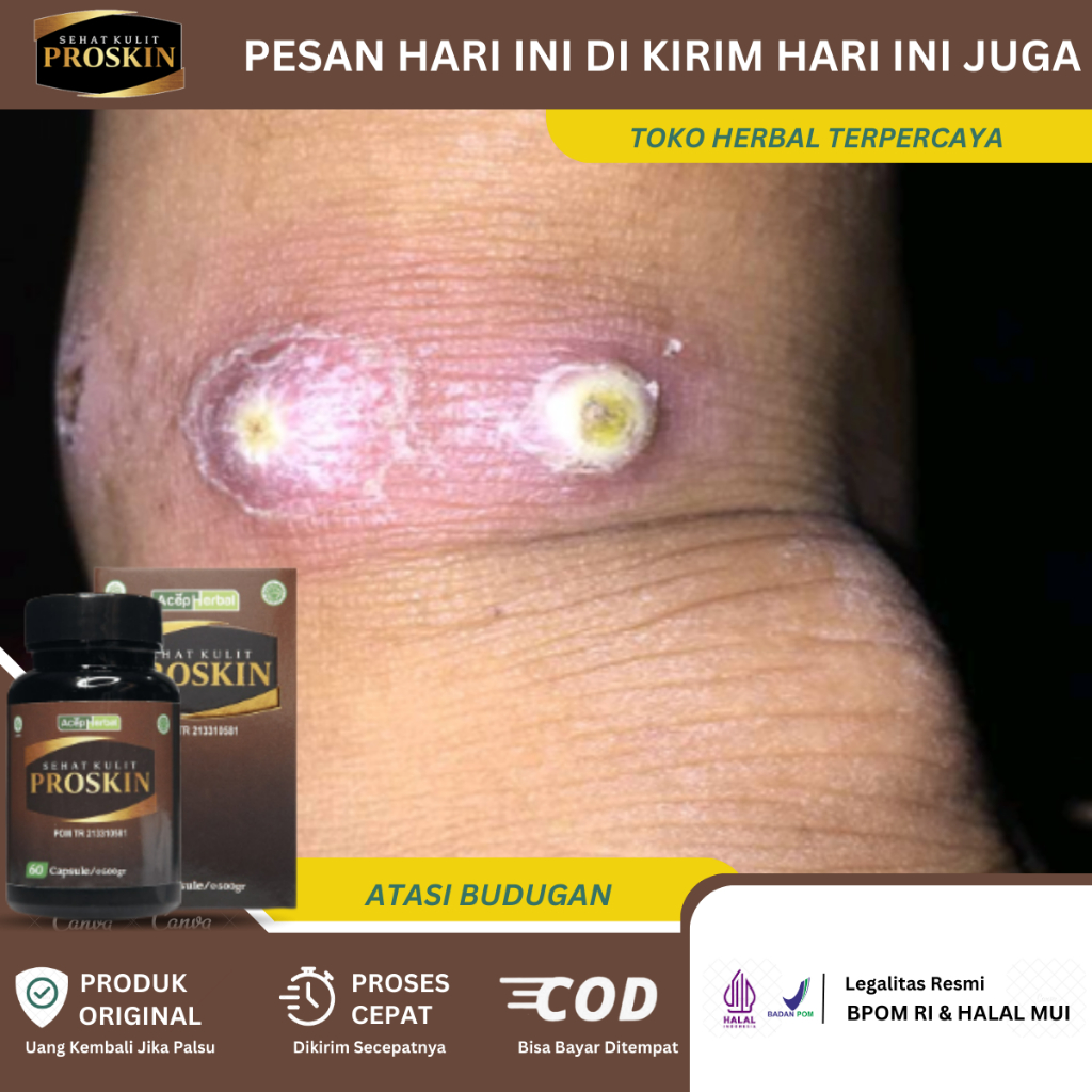 Jual Obat Budug, Obat Budug Bernanah, Obat Cenang, Obat Pengering Luka ...