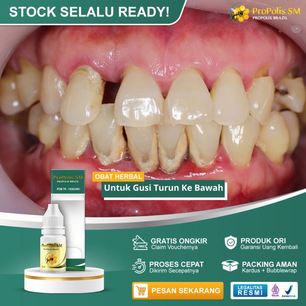 Jual Obat Gusi Turun Ke Bawah Resesi Gusi Gusi Bengkak Sakit Gusi Turun ...