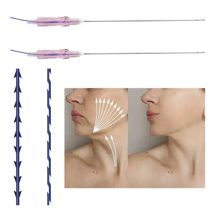 Jual Ella Benang Wajah piecesFISHBONE MOLDING 18G*100 PDO / PCL 2 ...