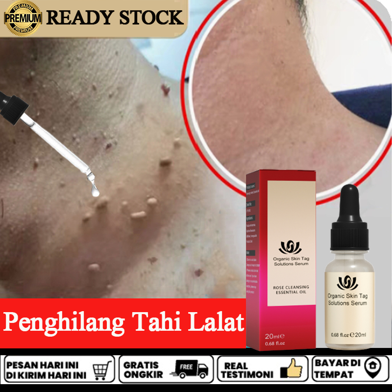 Jual Esensial penghilang tahi lalat Skin tag remover Menghilangkan ...