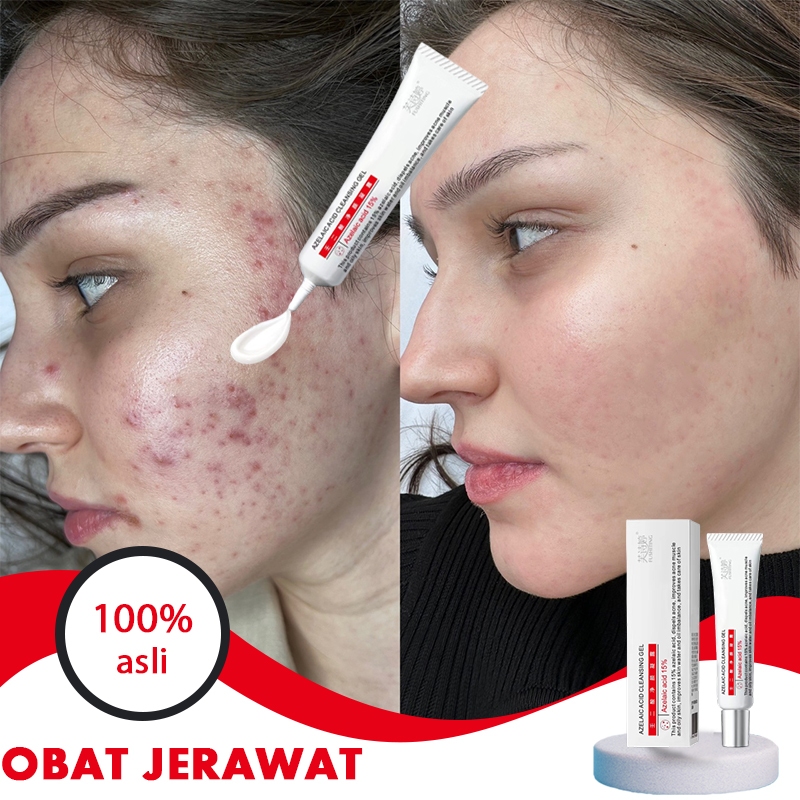 Jual Penghilang jerawat obat jerawat dan bekas jerawat penghilang bekas jerawat 20g Obat jerawat ...
