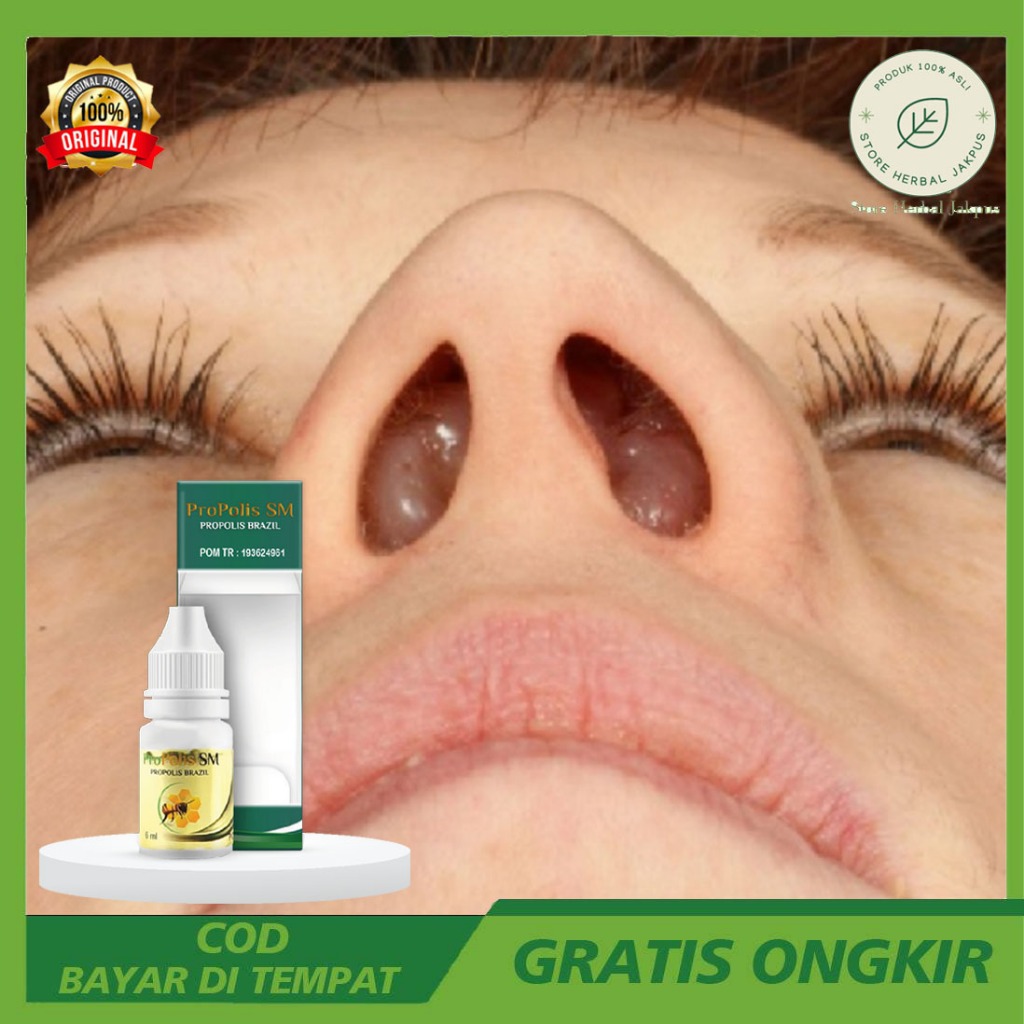 Jual Obat Polip Hidung Seperti Anggur Penghilang Benjolan Sinusitis - Propolis Sm | Shopee Indonesia