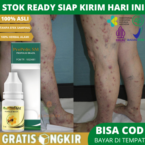 Jual Obat Oles Budug, Borok, Gatal Bernanah, Obat Budug di Kaki ...