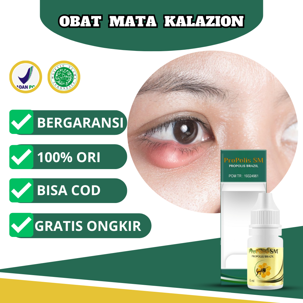 Jual Obat Oles Mata Kalazion, Benjolan Di Kelopak Mata, Kelopak Mata ...