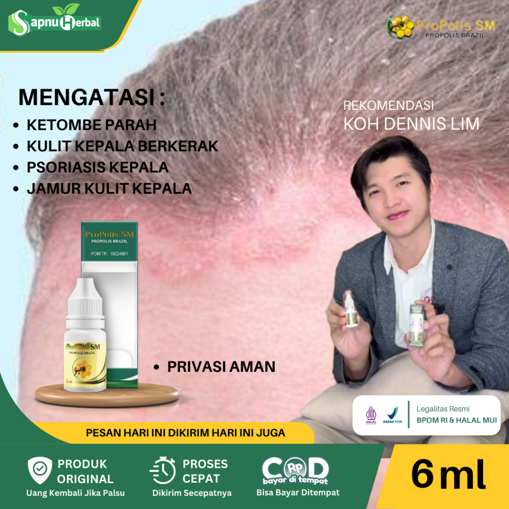 Jual Obat Psoriasis di Kepala, Kulit Kepala Berkerak, Ketombe Parah, Gatal Kulit Kepala, Jamur ...