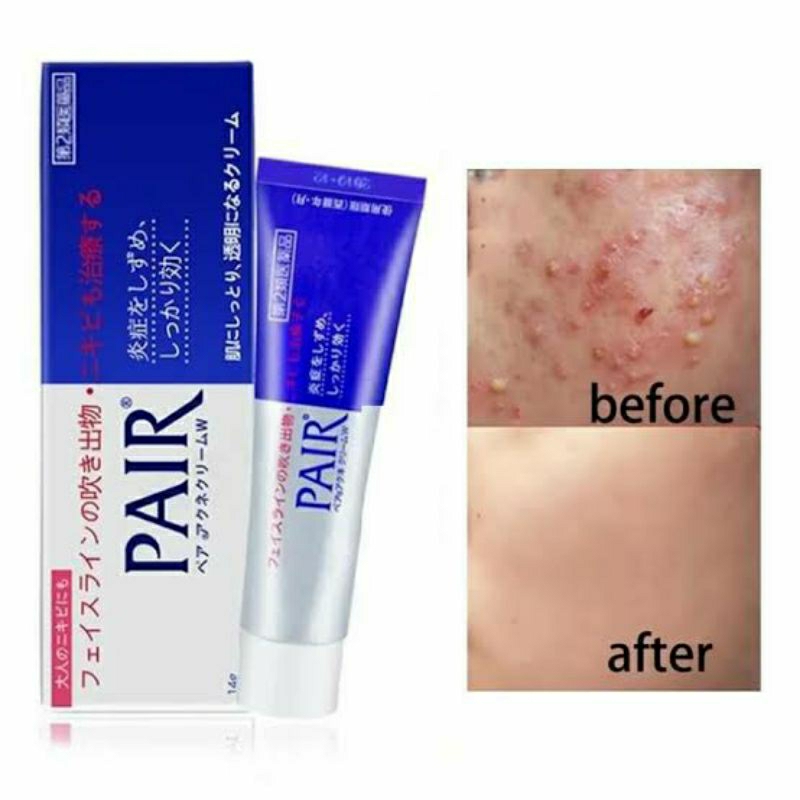 Jual 🇯🇵Lion pair acne cream acne gel spot care anti acne made in japan origin produk jepang ...