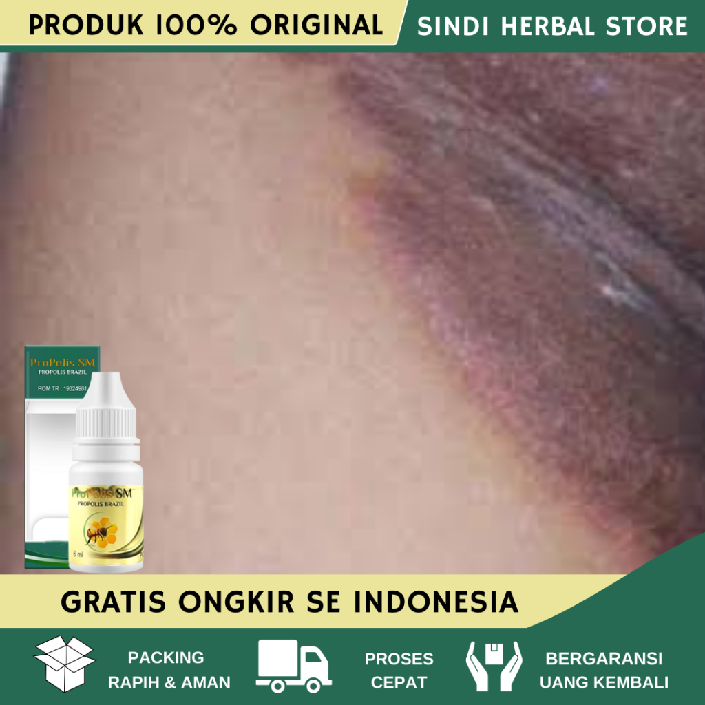 Jual Obat Selangkangan Lecet Berjamur - Obat Infeksi Jamur Kulit Paha ...