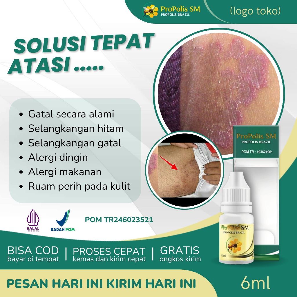 Jual Obat Selangkangan Gatal, Obat Alergi Dingin, Obat Alergi Makanan ...