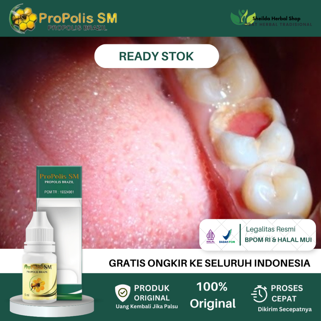 Jual Obat Polip Pulpa Gigi, Polip Gigi Berlubang, Daging Tumbuh di Gigi ...