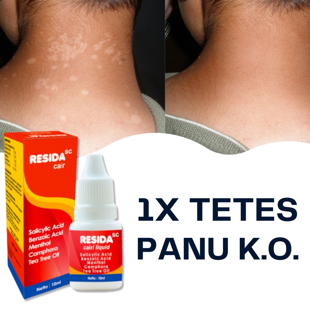 Jual Resida Cair Obat Panu Original Obat Panu Paling Ampuh 100% Cair ...