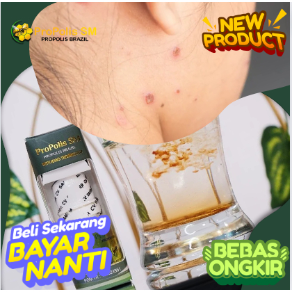 Jual salep penghilang bekas cacar yang berlubang, penghilang bekas ...