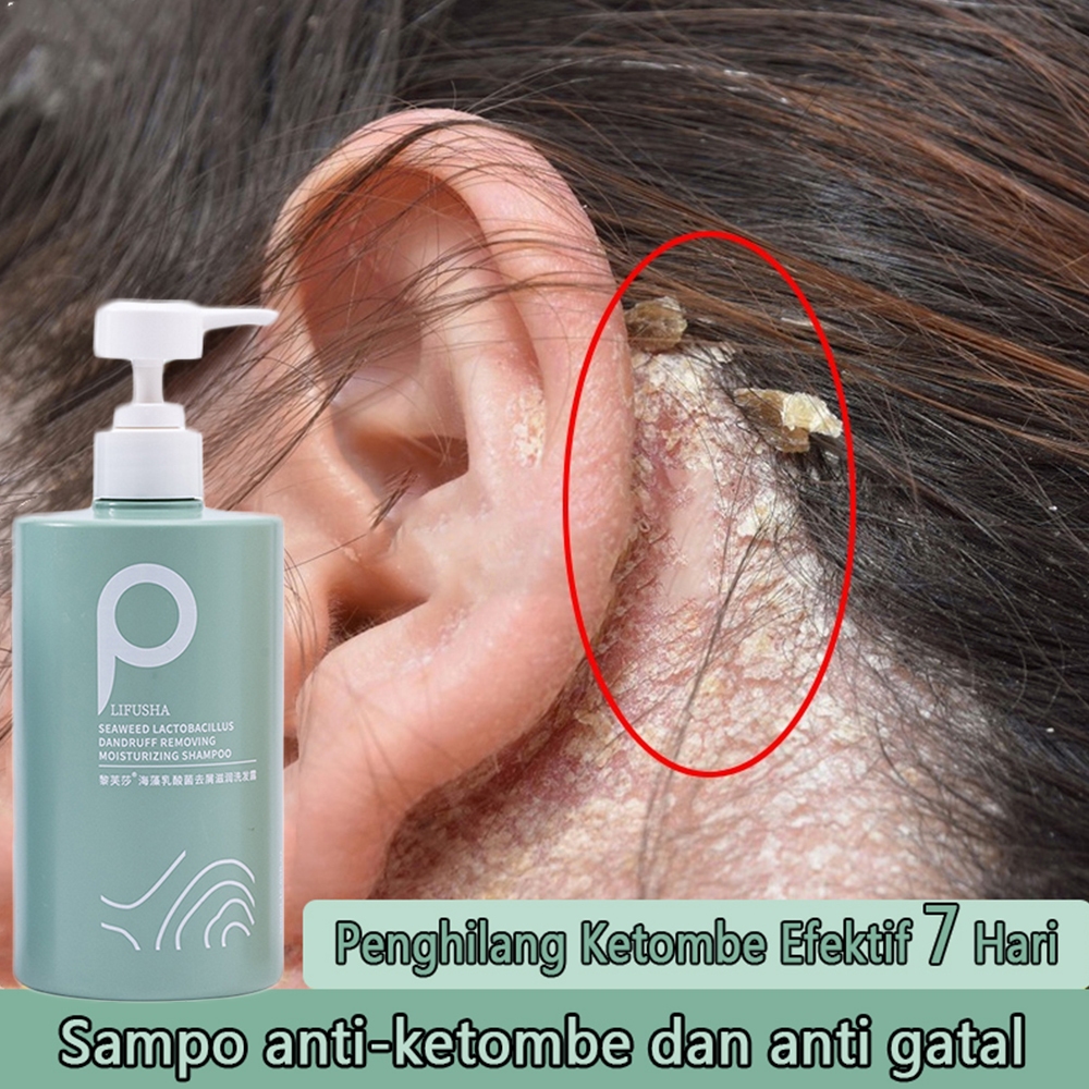 Jual Shampo anti ketombe sampo anti ketombe dan rontok Penghilang Ketombe Gatal Psoriasis kulit ...