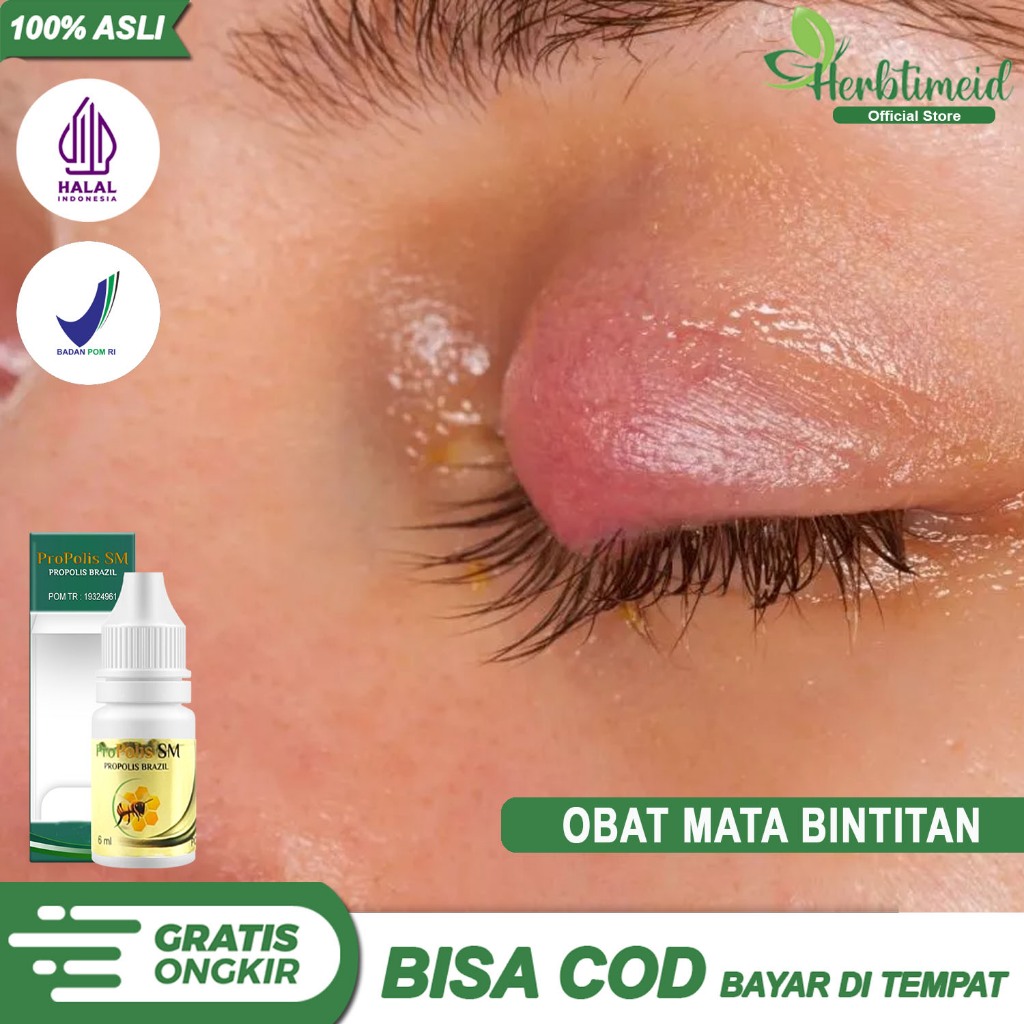 Jual Obat Mata Bintitan Kalazion - Penghilang Benjolan Di Kelopak Mata ...