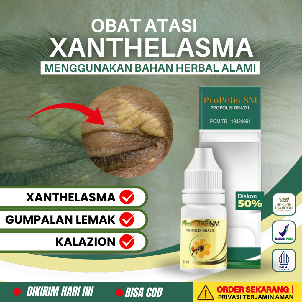 Jual Obat Xanthelasma Penghilang Gumpalan Lemak Di Kelopak Mata Plak ...