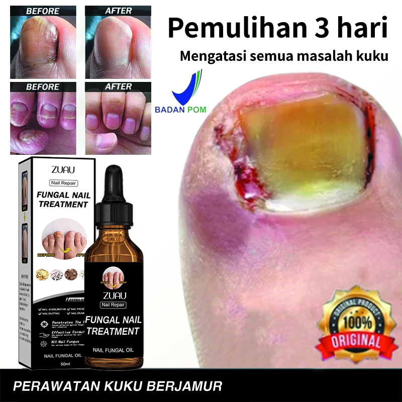 Jual Obat Jamur Kuku Obat kuku jamur dan rusak Perawatan Kuku Berjamur ...