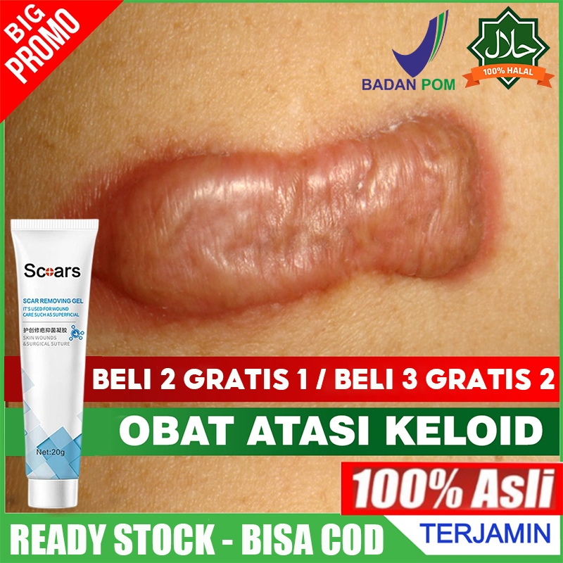 Jual Obat Penghilang Bekas Luka Lama Hitam Koreng Bakar Knalpot Jerawat ...