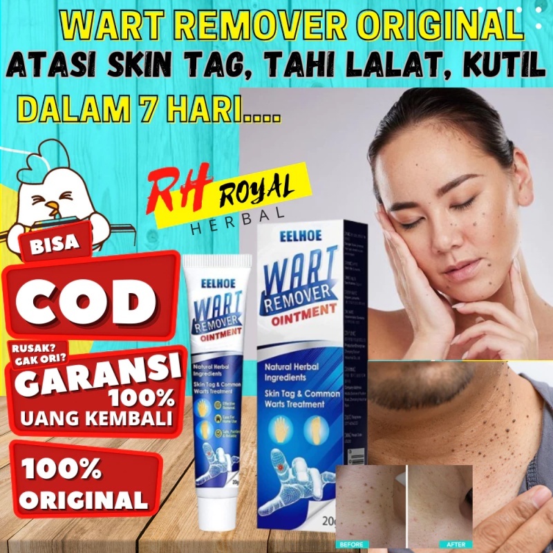 Jual 🟥𝟏𝟎𝟎% 𝒐𝒓𝒊𝒈𝒊𝒏𝒂𝒍🟥𝗦𝘂𝗺𝗶𝗳𝘂𝗻 𝗪𝗮𝗿𝘁 𝗥𝗲𝗺𝗼𝘃𝗮𝗹 𝗦𝗸𝗶𝗻 𝗧𝗮𝗴 Sumifun Wart Removal ...