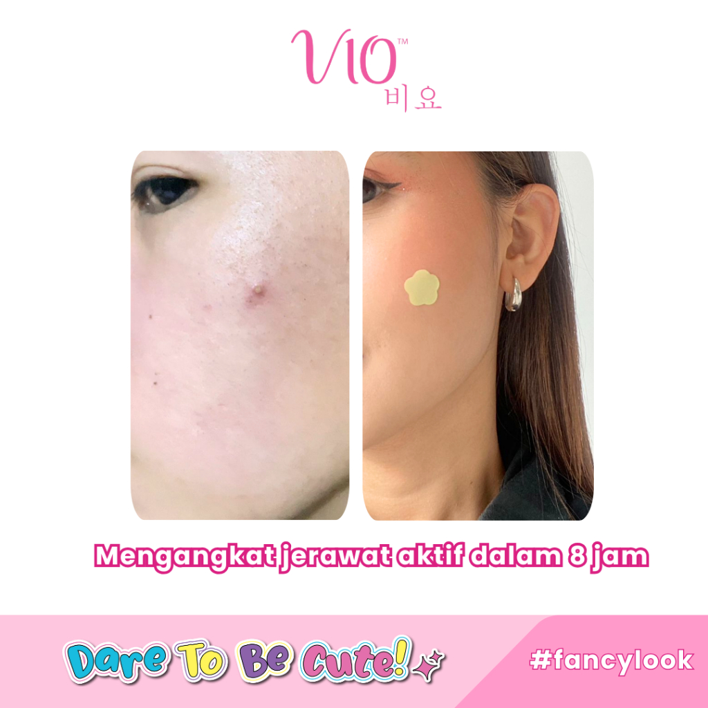 Jual [50% OFF]Vio Acne Shield Patch Petite Ocean -24 Patch - patch ...