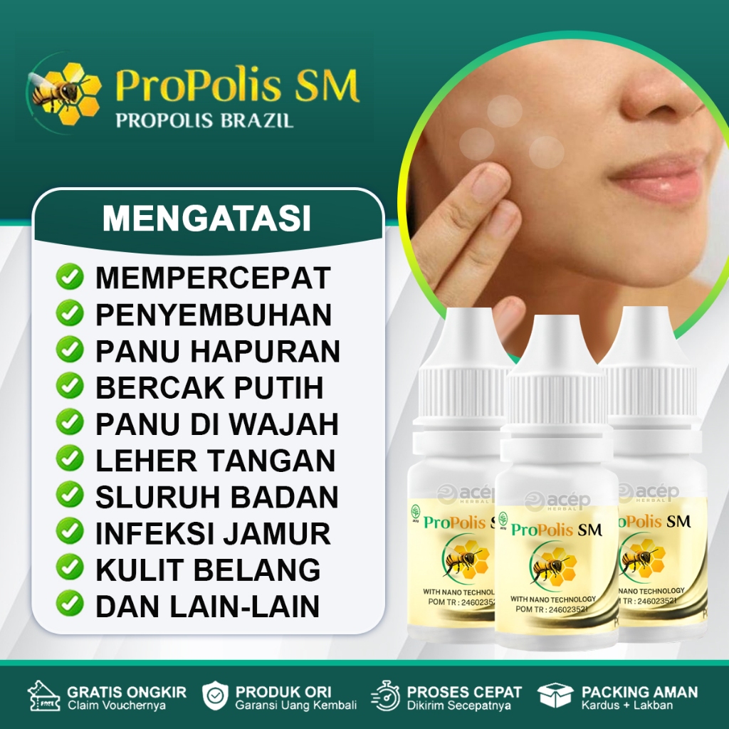 Jual Obat Panu Di Wajah Bercak Putih Di Wajah Pipi Leher Kulit Belang ...