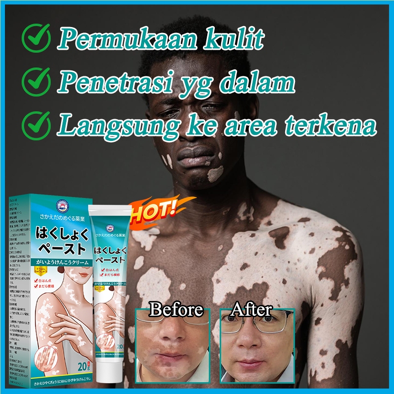 Jual Salep Vitiligo Penghilang Pigmentasi Putih Di Tubuh 20g Menghilang ...