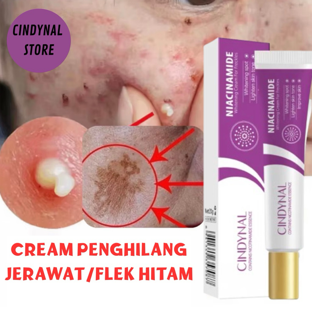 Jual [BPOM] COD GRATIS ONGKIR Cindynal Obat Cream Penghilang Jerawat Bintik Hitam Flek Hitam ...