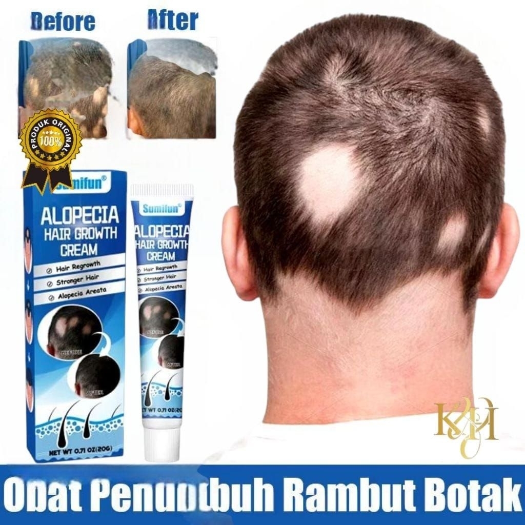 Jual K&H Alopecia Hair Growth Cream , Penumbuh Rambut Botak Koin Pria ...