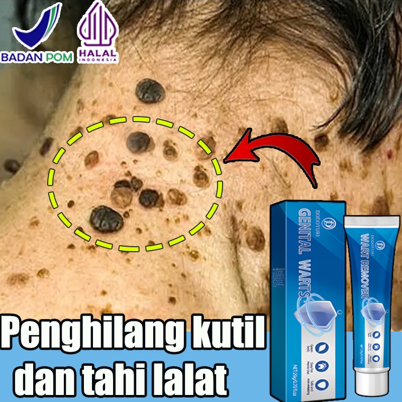 Jual Penghilang kutil dan tahi lalat Salep kutil paling ampuh 20g Obat ...