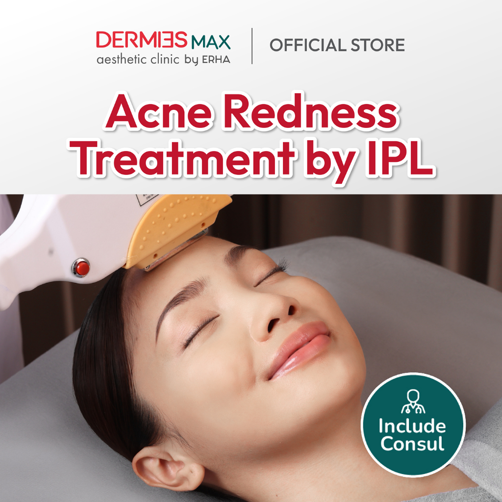 Jual Dermies Max Acne Redness Treatment By IPL | Shopee Indonesia