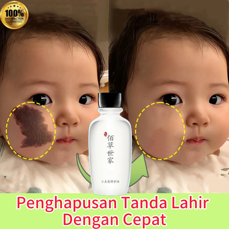 Jual Obat Penghilang Tanda Lahir Penghilang tanda lahir coklat Hapus ...