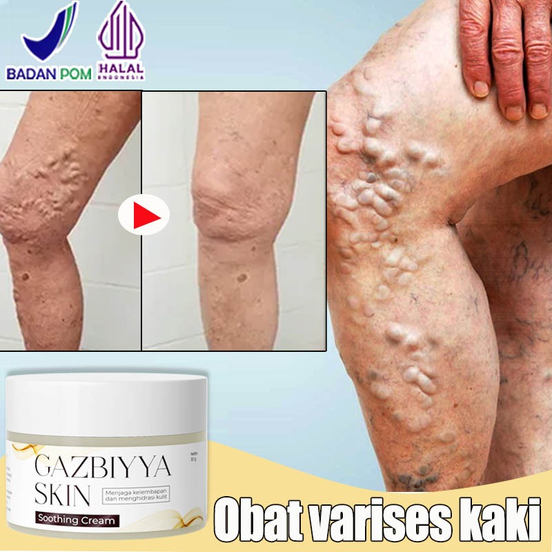 Jual Thryve Obat varises kaki Salep varises paling ampuh Varicozy cream ...