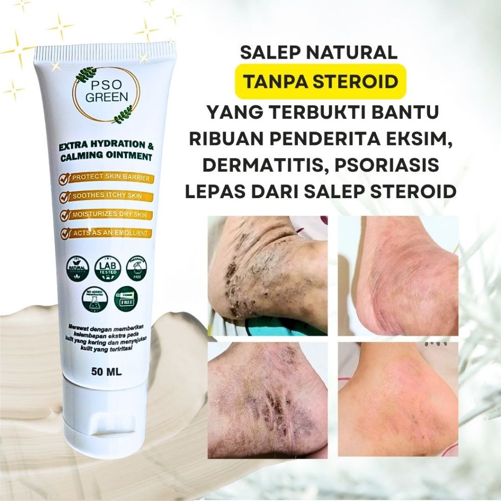 Jual 50 ML Psogreen Salep Gatal Ampuh Selangkangan,Ketiak,Eksim,Infeksi ...
