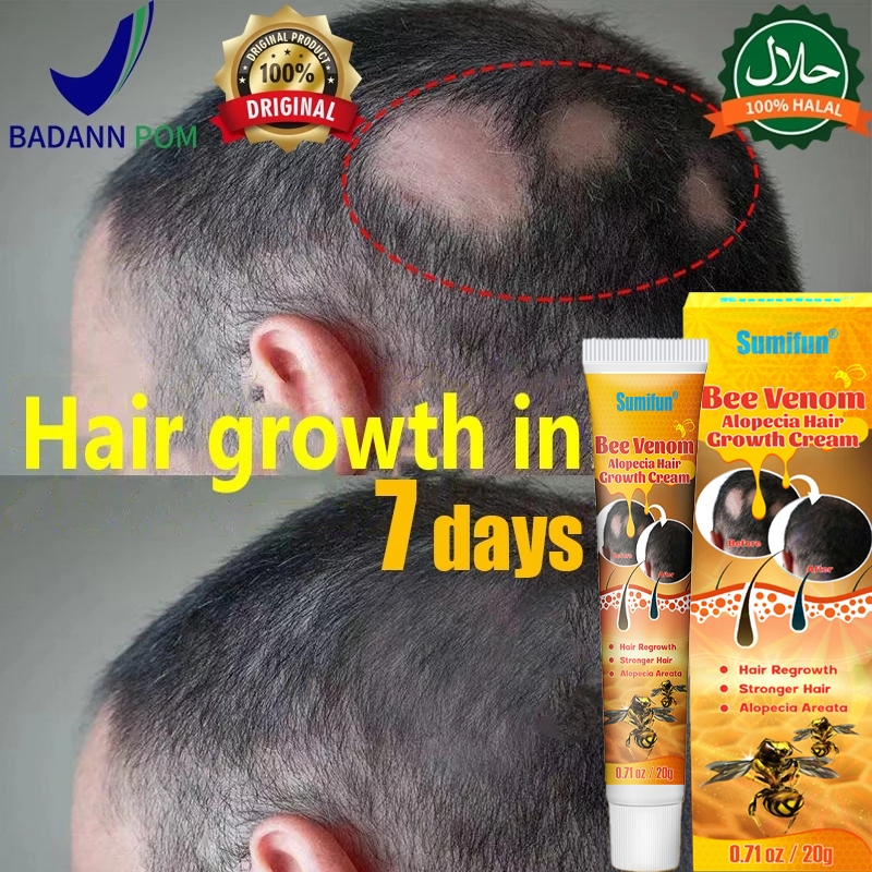 Jual Obat Alopecia Areata 20g Alopecia Hair Growth Cream Penumbuh ...