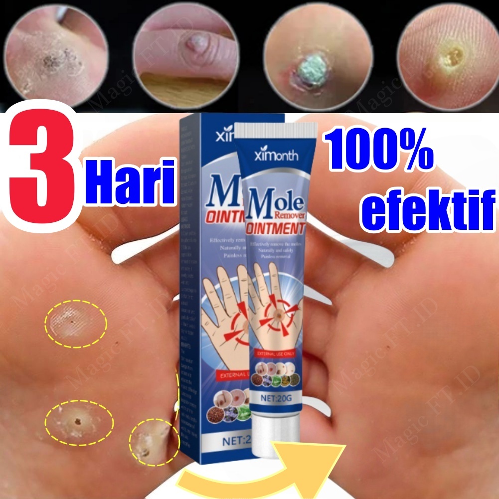Jual Obat Mata Ikan Salep Mata Penghilang Kutil Dan Tahi Lalat Foot ...