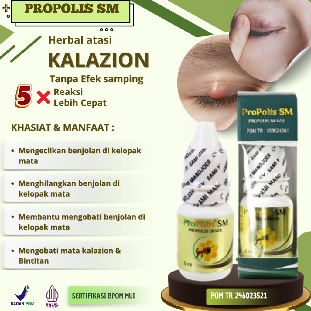 Jual Obat Mata Kalazion Di Kelopak Mata Penghilang Mata Bintilan ...