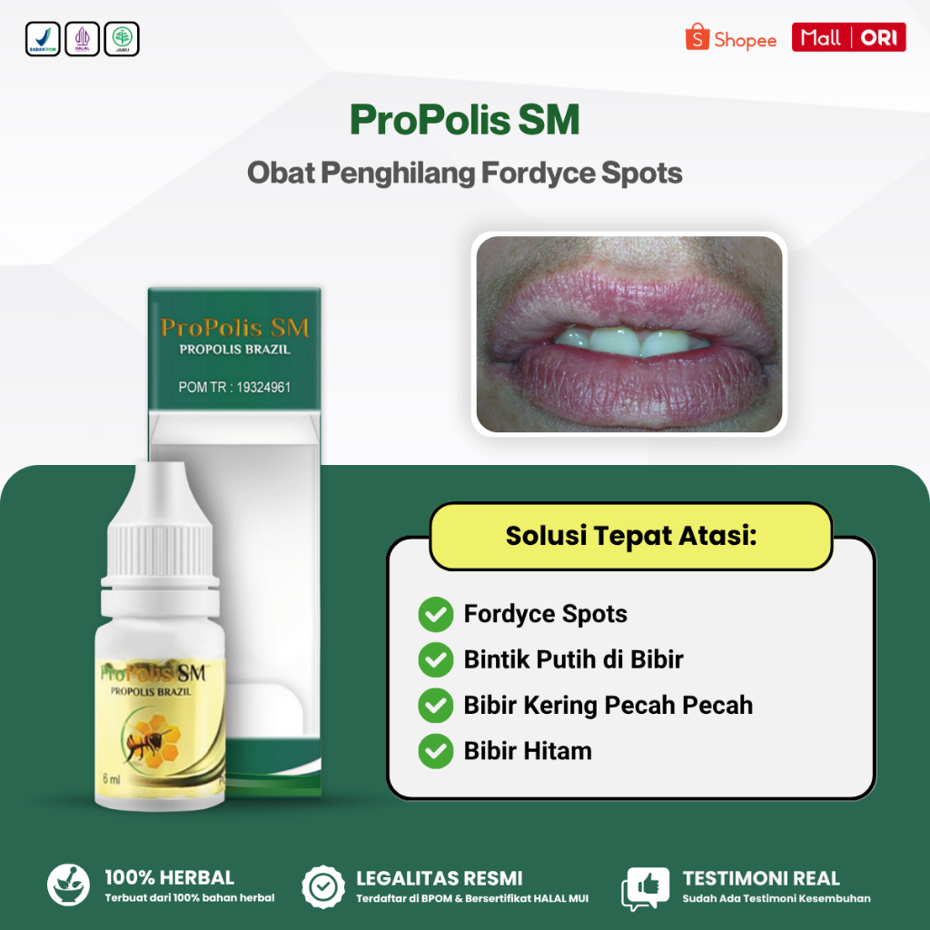 Jual Obat Penghilang Fordyce Spots Bintik Putih di Bibir, Sariawan ...