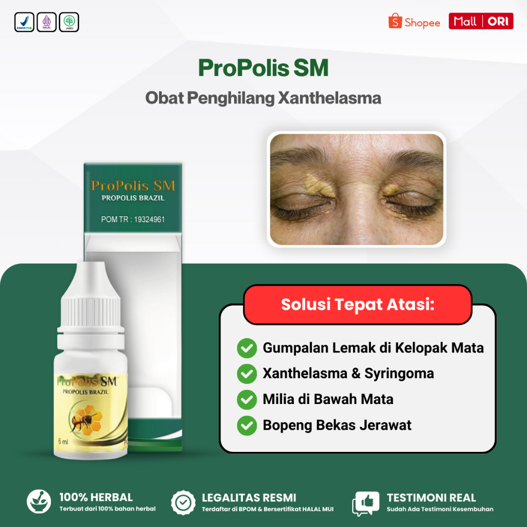 Jual Propolis SM - Obat Penghilang Gumpalan Lemak Di Kelopak Mata ...