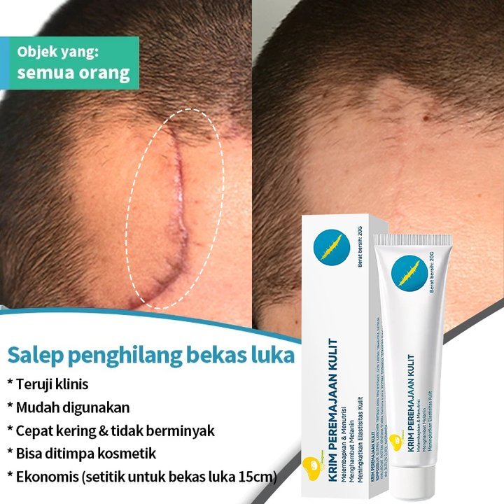 Jual Mangoman Salep Penghilang Bekas Luka 20g! Menghilangkan stretch ...