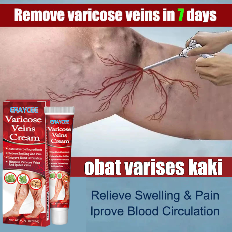 Jual Salep varises 20g obat varises original obat varises di kaki dan ...