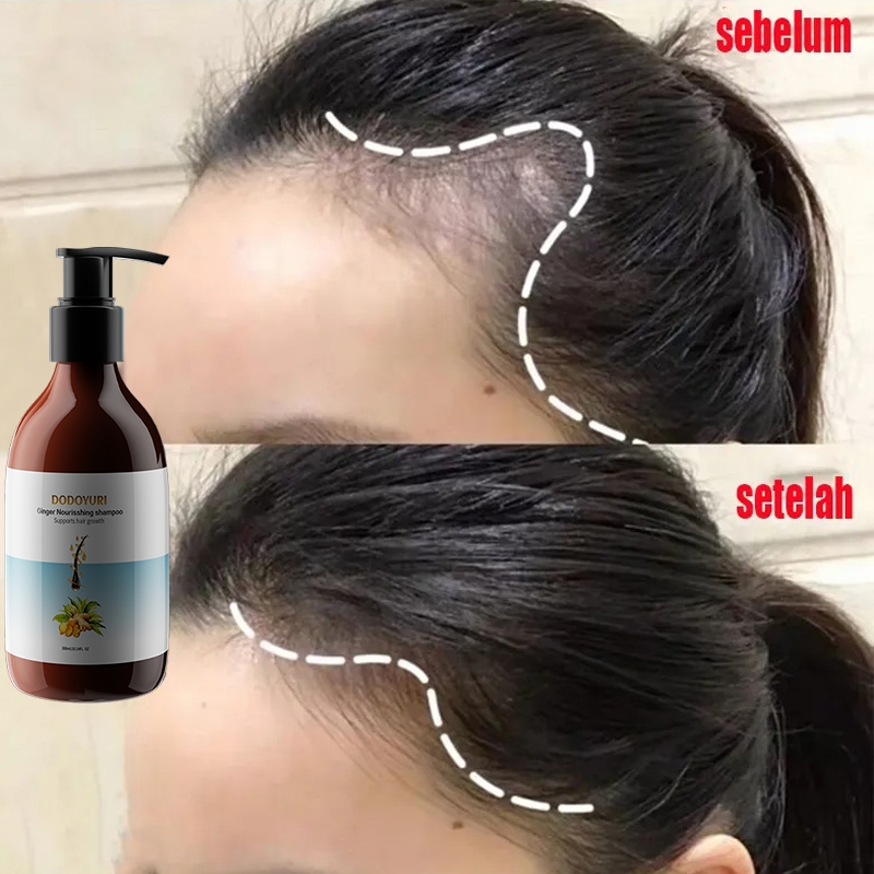 Jual Shampo penumbuh rambut cepat shampoo rambut rontok dan ketombe penumbuh rambut botak 300ml ...