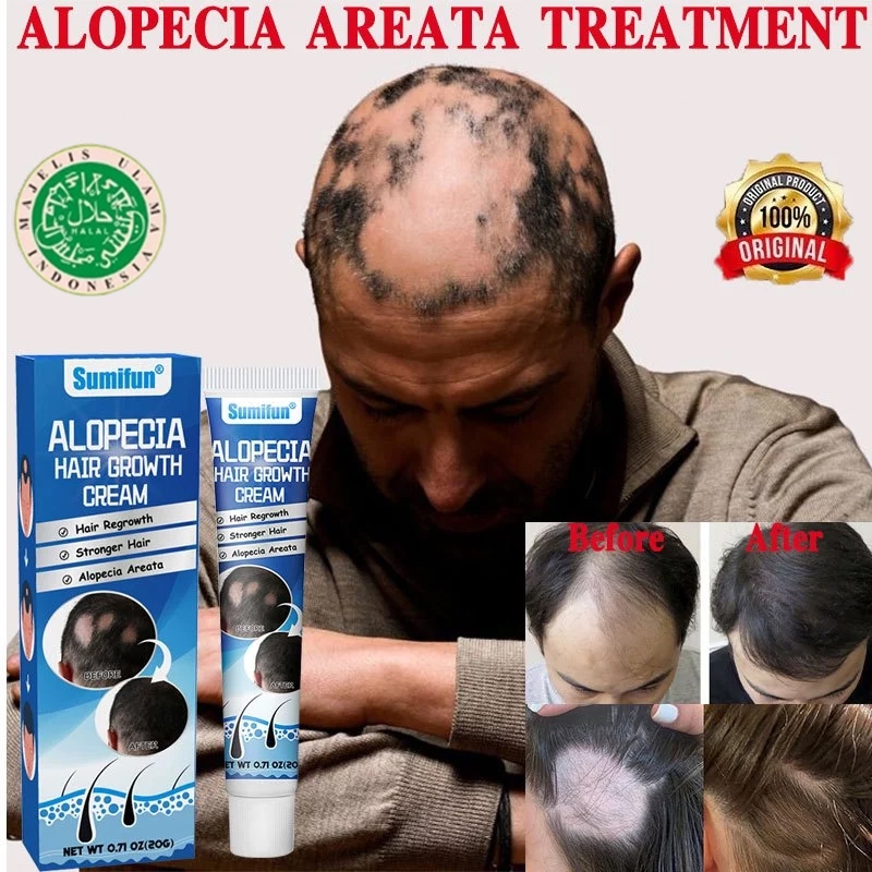 Jual Obat penumbuh rambut Obat Alopecia Areata Penumbuh rambut cepat ...